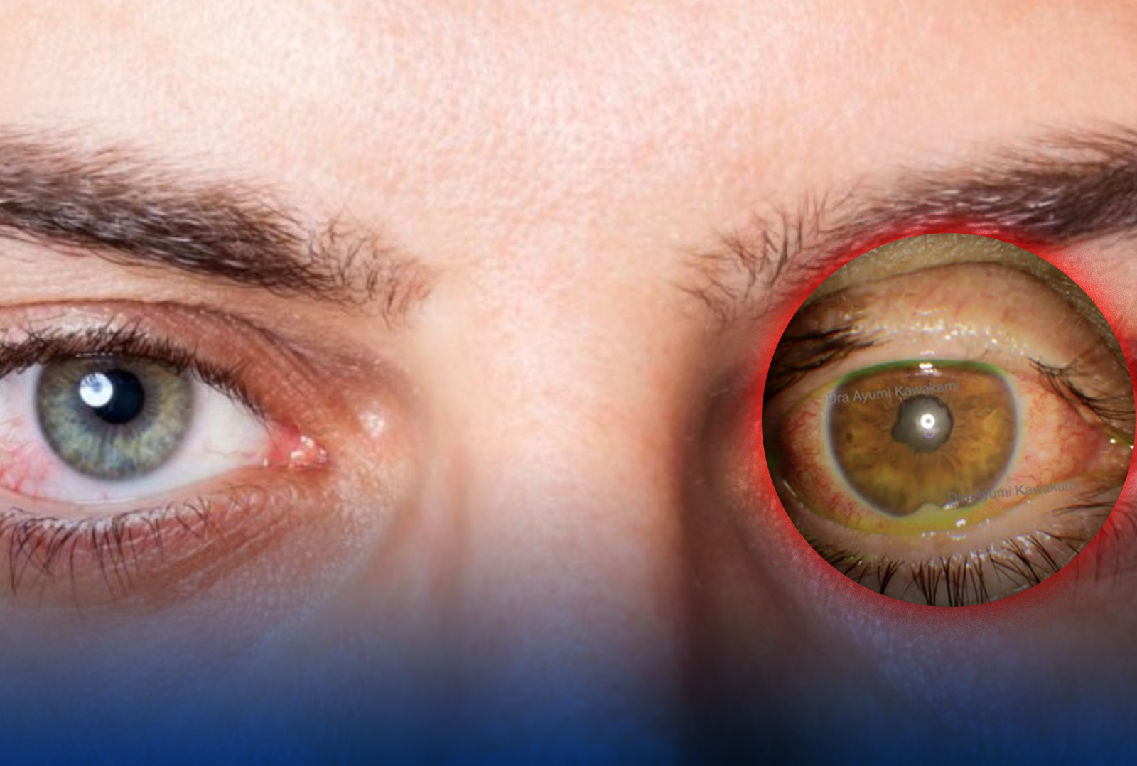 Casos de sífilis ocular por cepa desconocida causa alerta en EEUU ‣ La ...